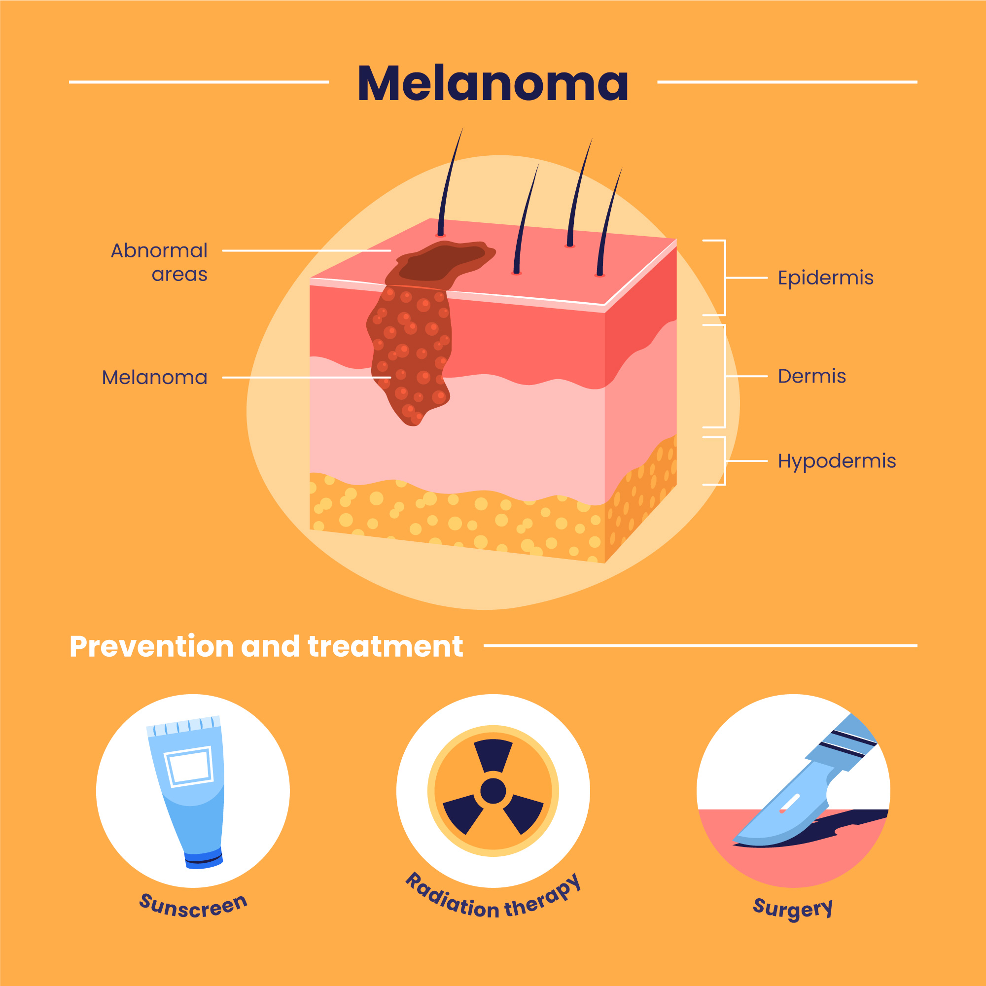 Melanoma: Symptoms, Causes, Diagnosis & Treatment | NEUMEDIX