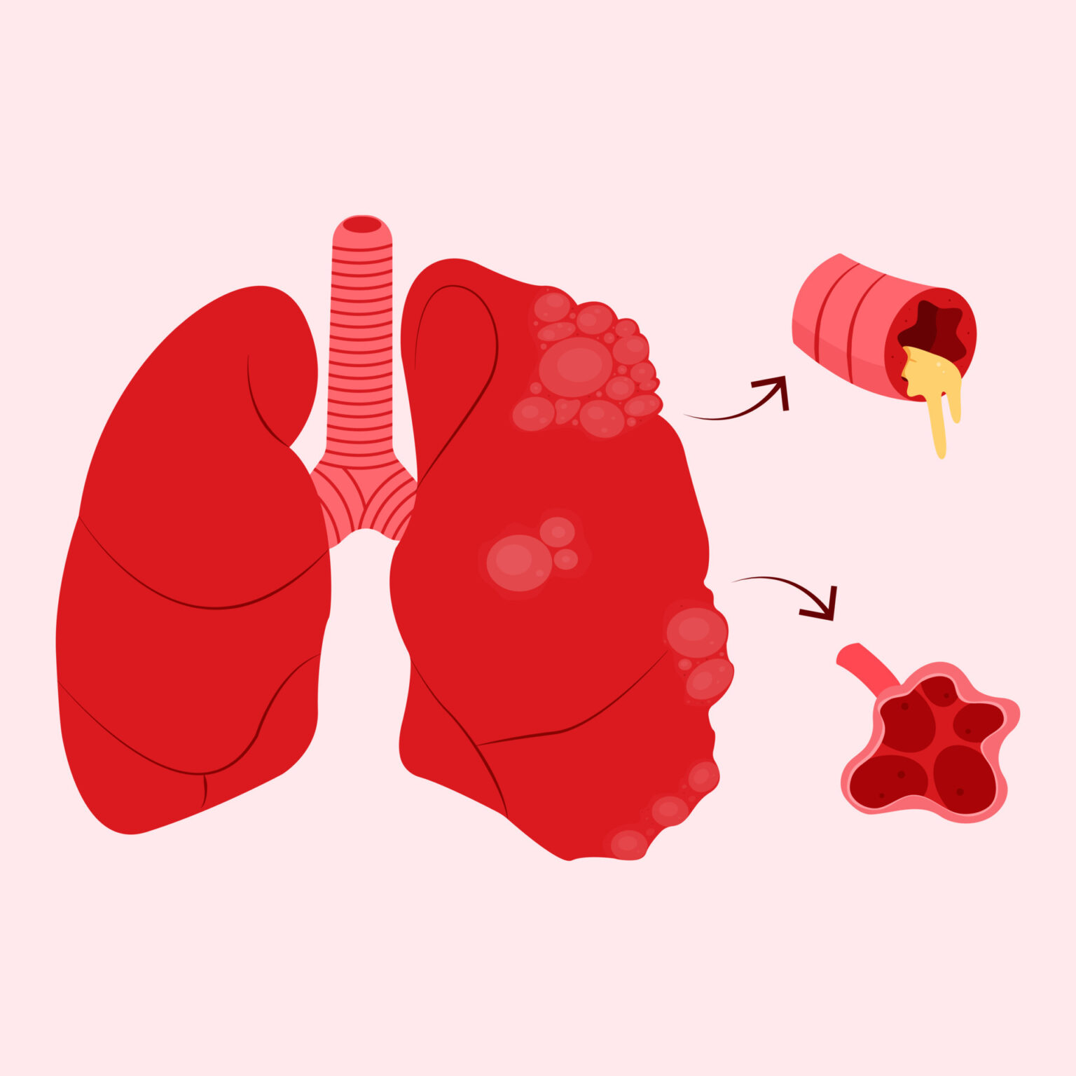 What is Emphysema: A Guide to COPD and Pink Puffer Syndrome